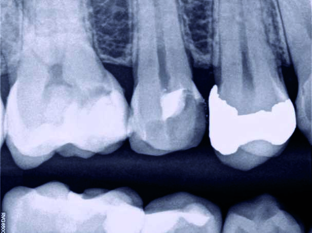 Dental News - Direct pulp capping as a conservative procedure to ...