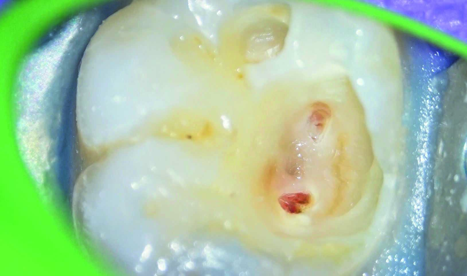 Dental News - Direct pulp capping as a conservative procedure to ...