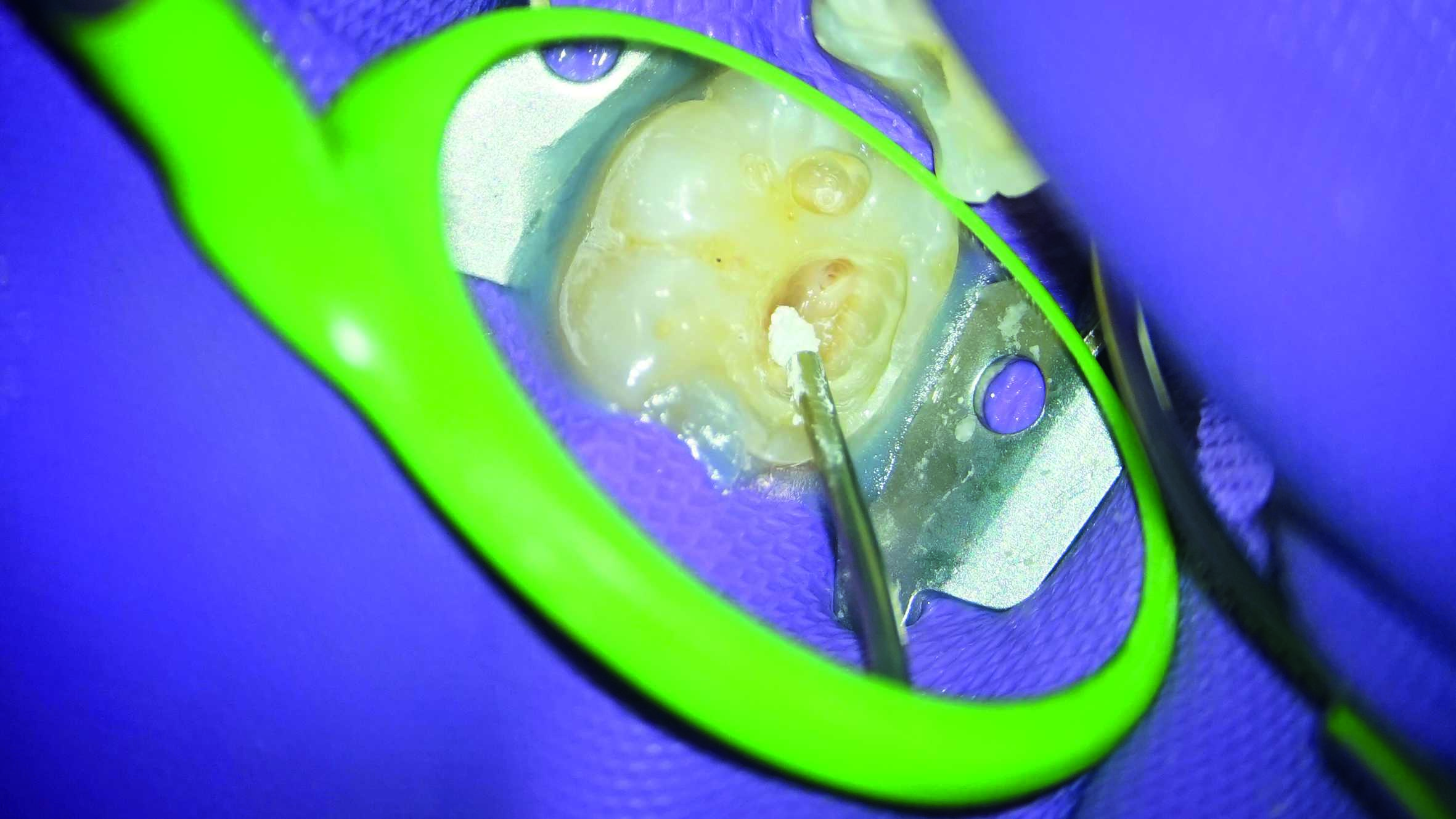 Dental News - Direct pulp capping as a conservative procedure to ...