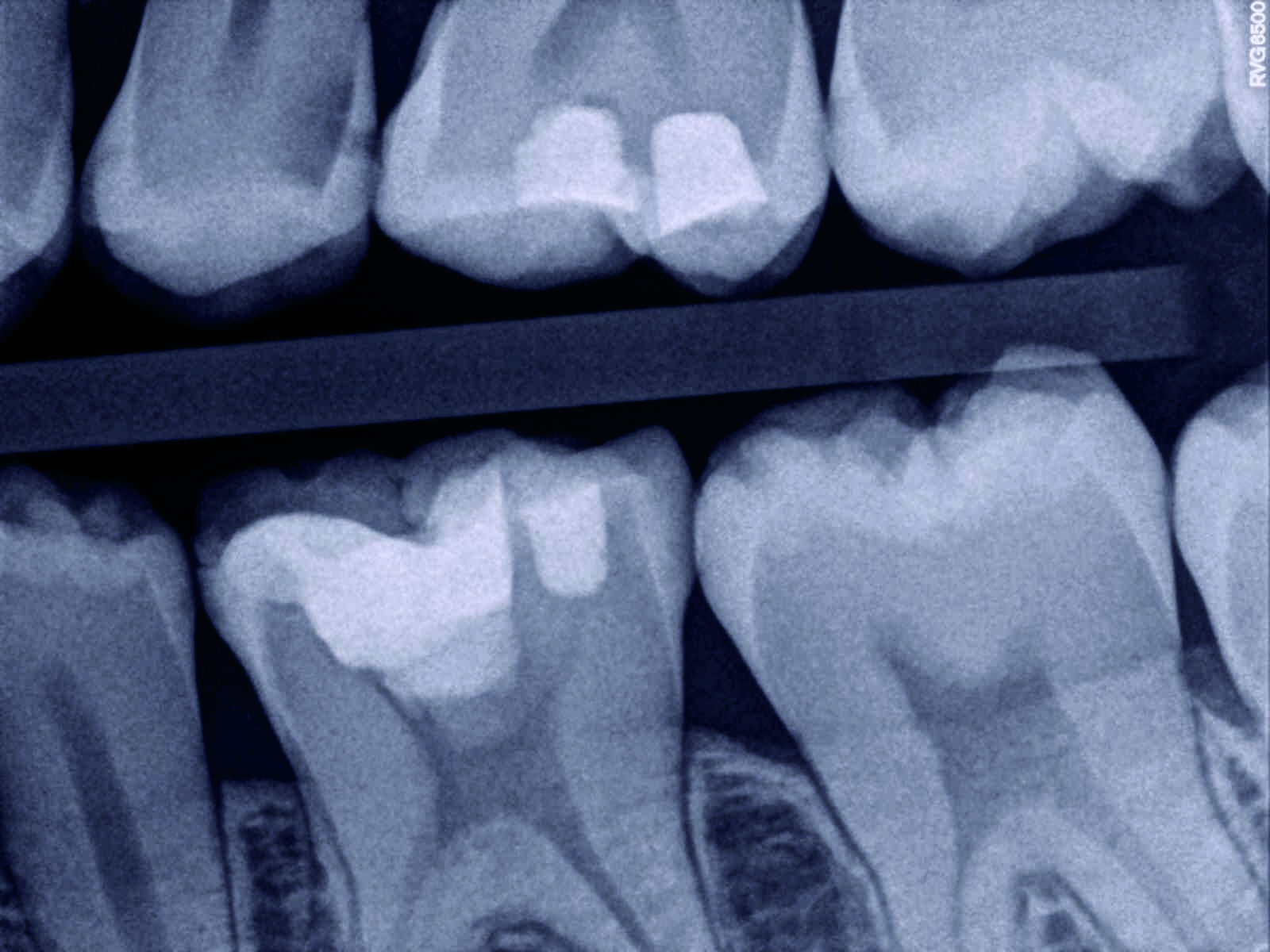 Dental News - Direct pulp capping as a conservative procedure to ...