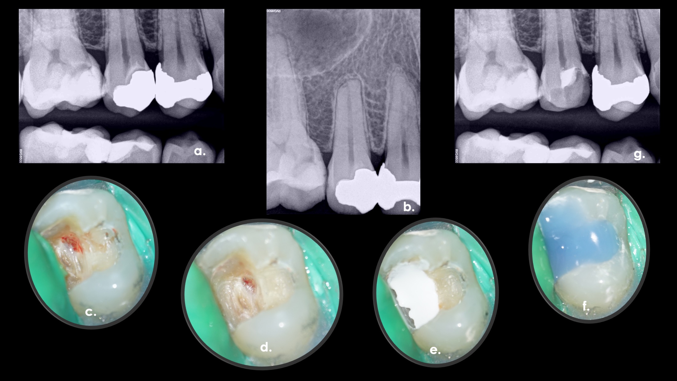 Dental News - Calcium silicate-based endodontic materials: A clinical ...