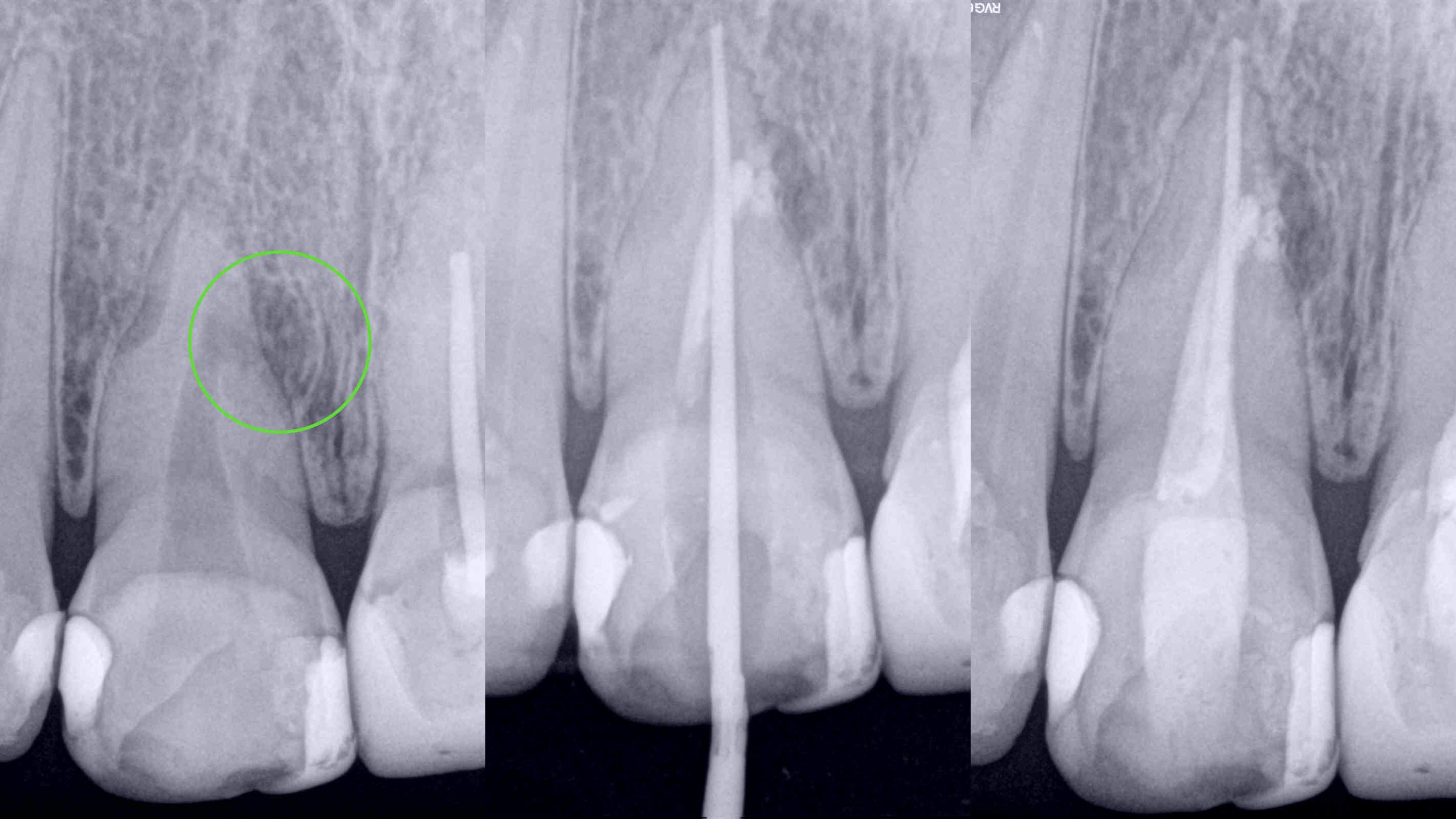 Dental News - Calcium silicate-based endodontic materials: A clinical ...