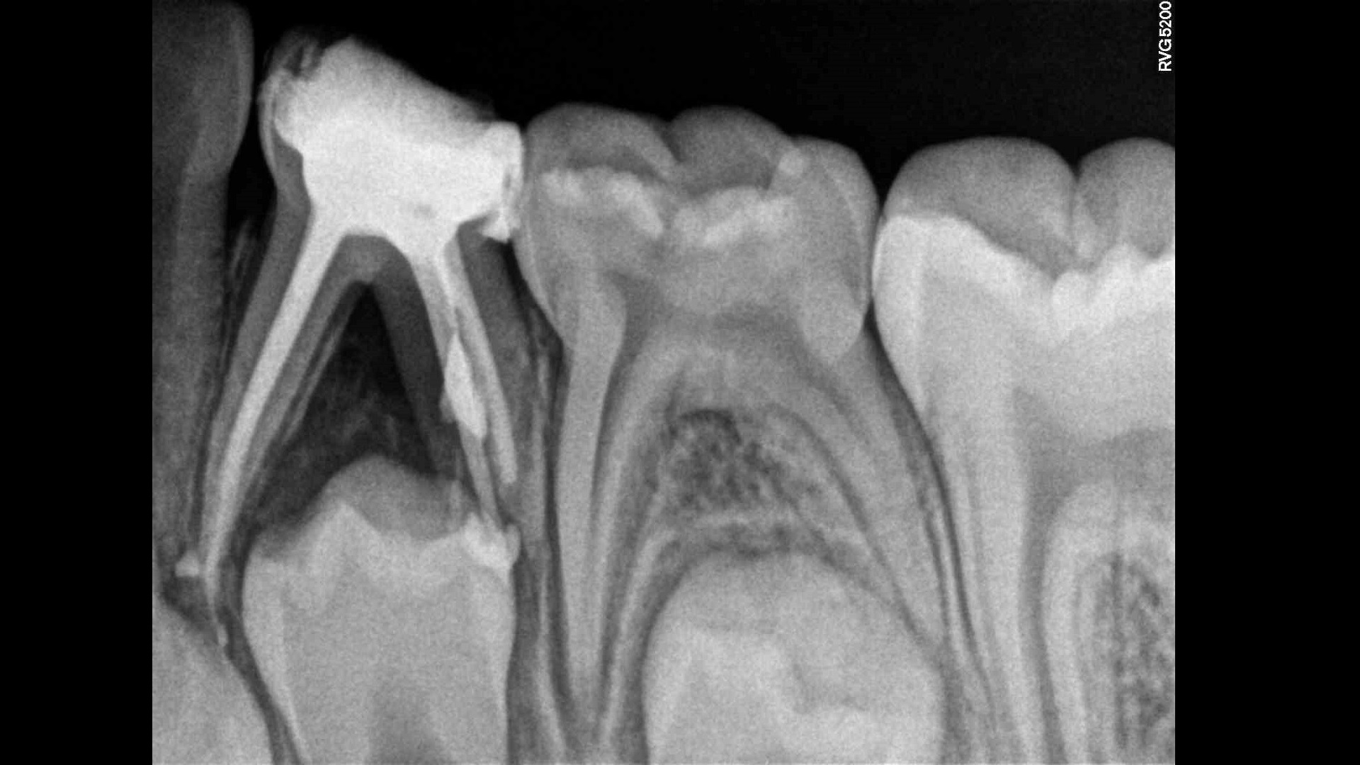 Dental News - Root canal therapy of necrotic primary molars—using a ...