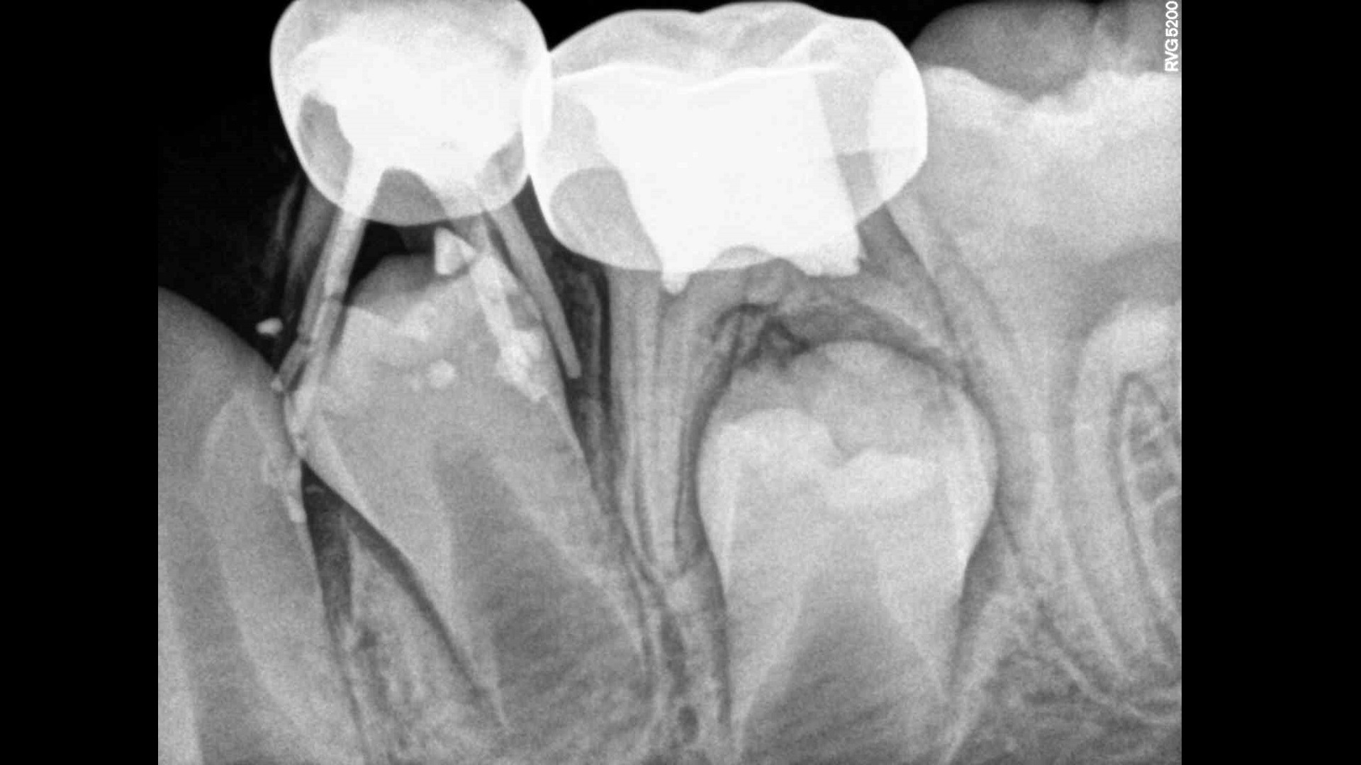 Dental News - Root canal therapy of necrotic primary molars—using a ...