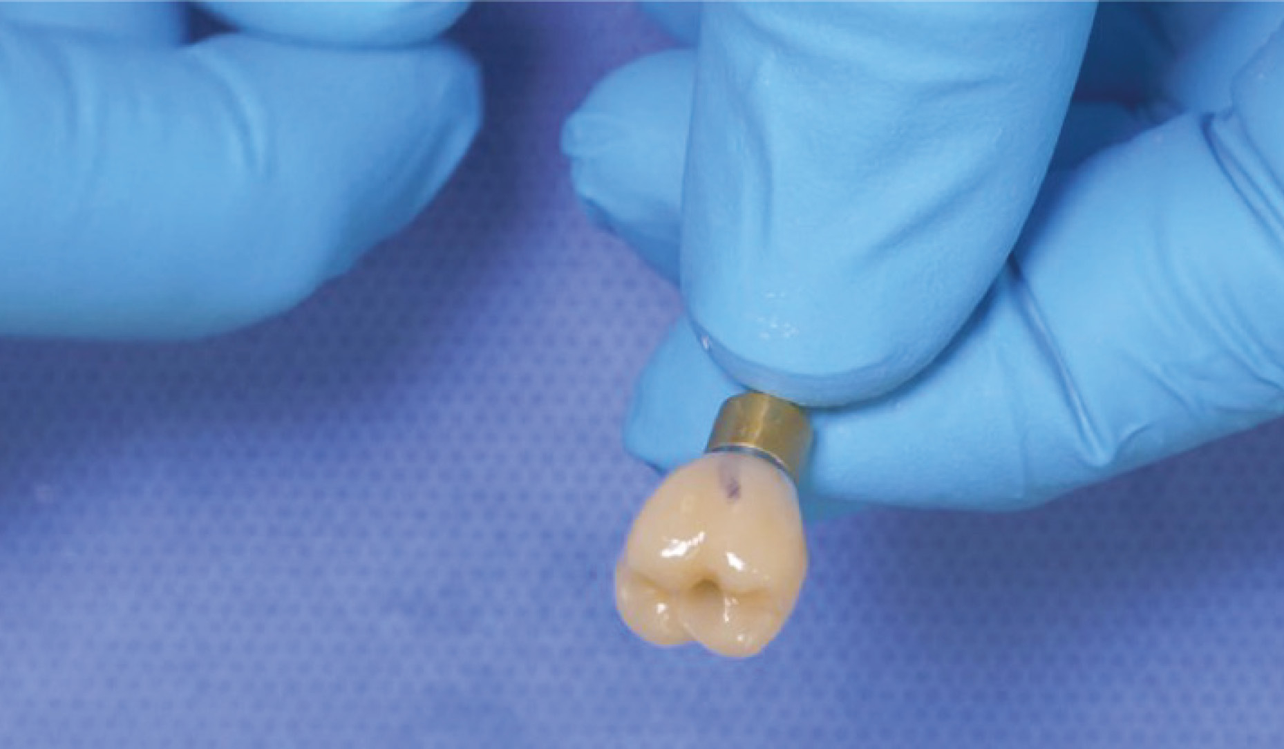 Titanium base implant cementation technique